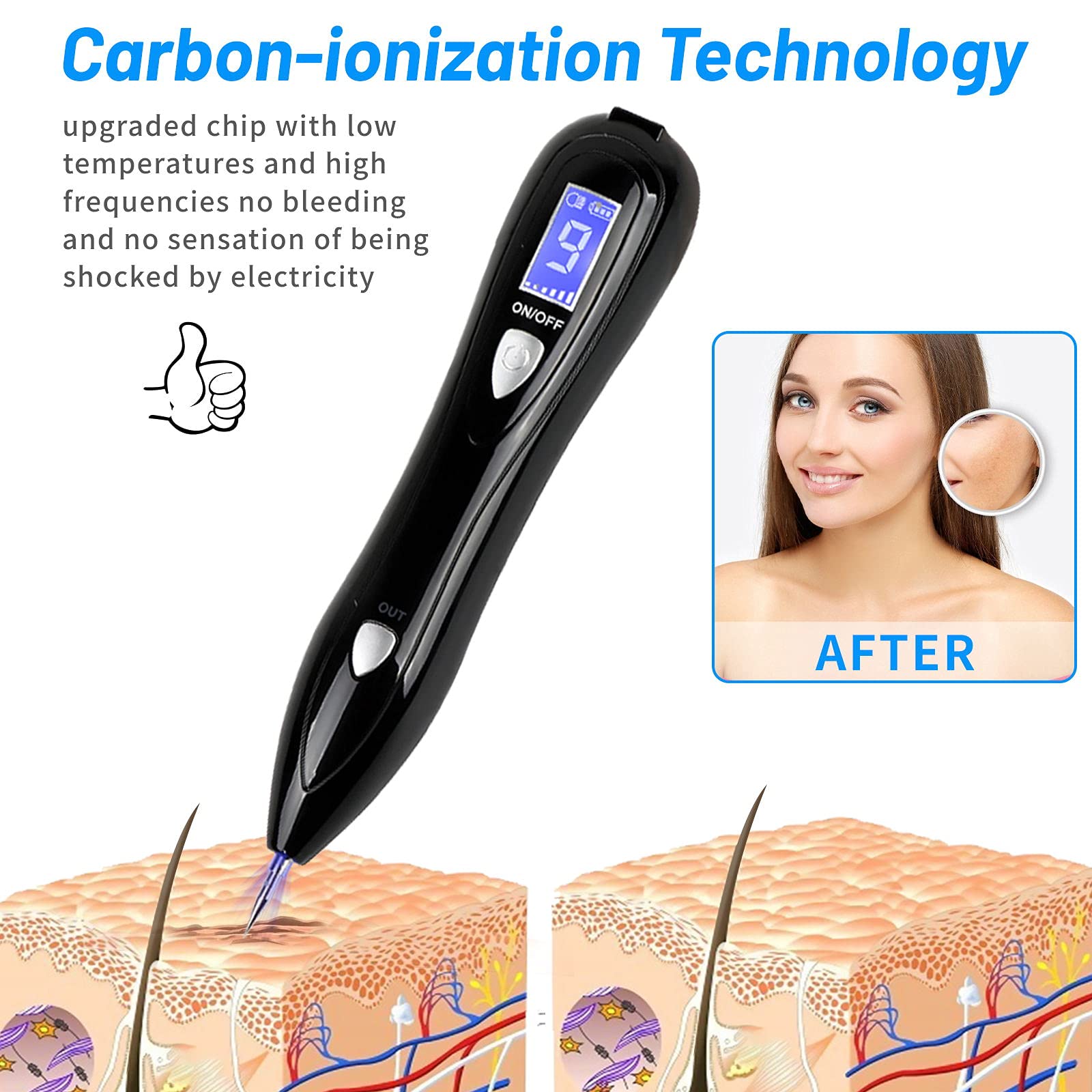 Buy CHRERNA Skin Tags Remover Pen, Portable Rechargeable Mole Remover ...