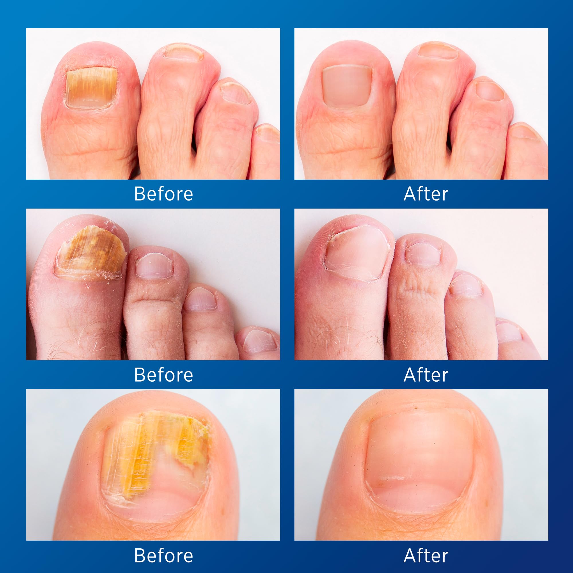 Snapklik.com : Toenail Fungus Treatment Nail Patches Extra Strength ...