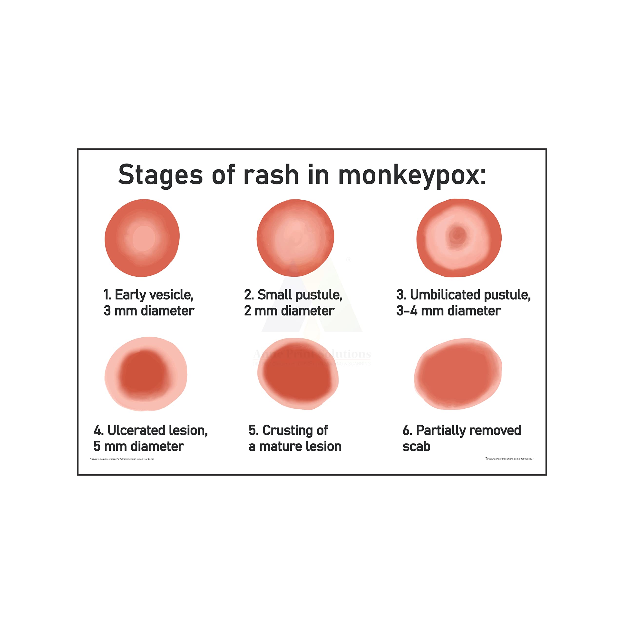 Anne Print Solutions® Stages of rashes in monkeypox chart Posters For ...