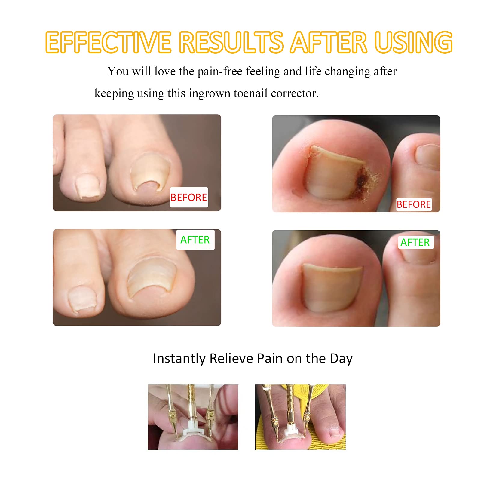 Buy Ingrown Toenail Treatment Kit, Ingrown Toenail Corrector Stainless ...