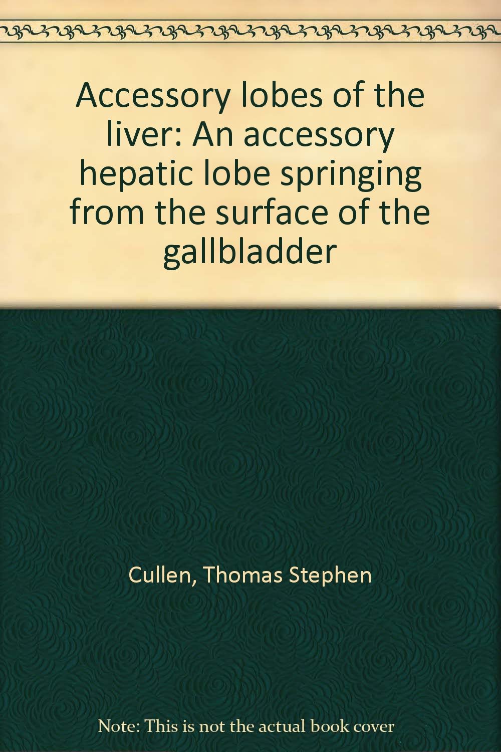 Accessory lobes of the liver: An accessory hepatic lobe springing from ...