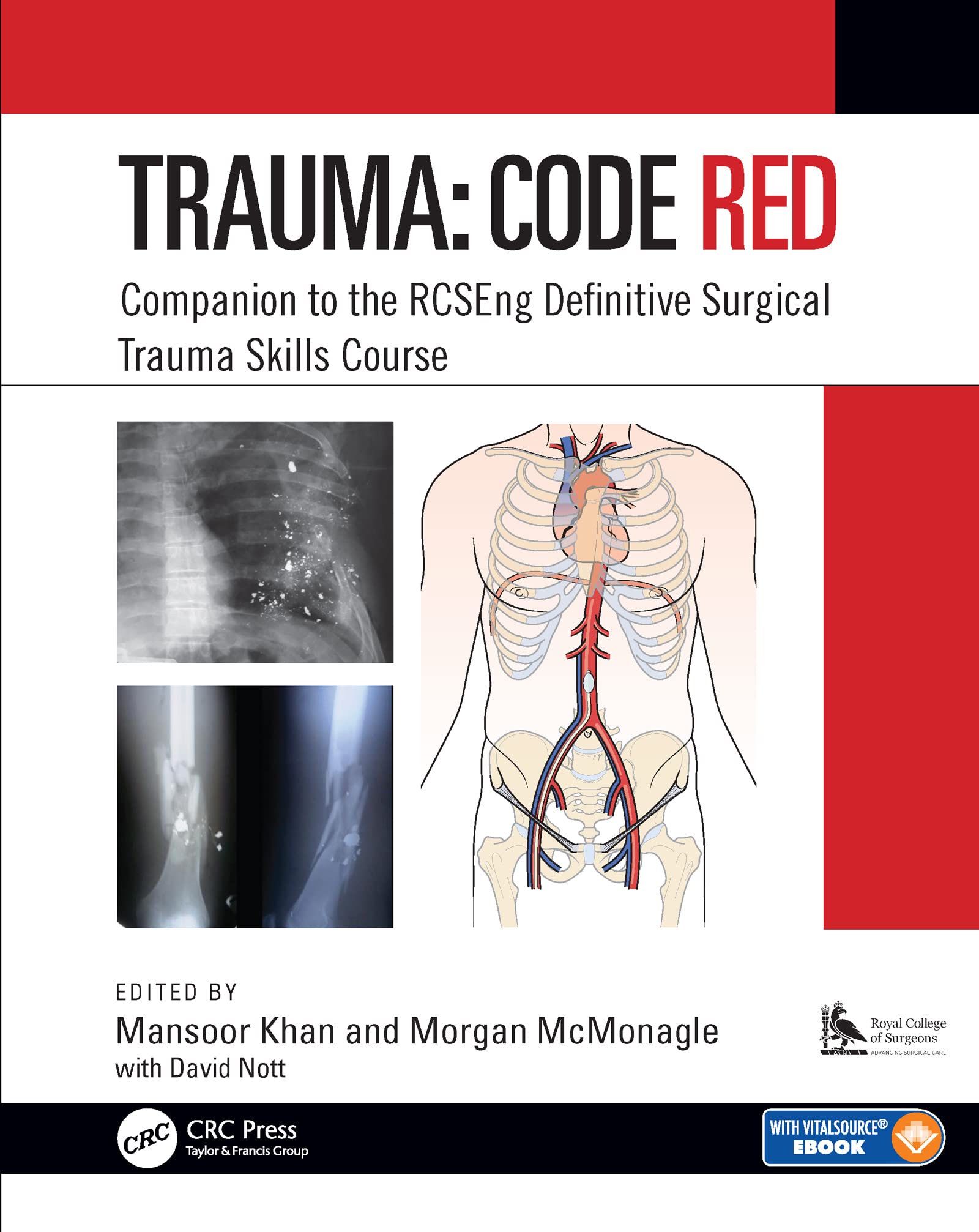 Trauma: Code Red: Companion to the RCSEng Definitive Surgical Trauma ...