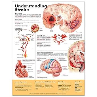 Understanding Stroke Anatomical Chart: Anatomical Chart Company: 9781587799877: Amazon.com: Books
