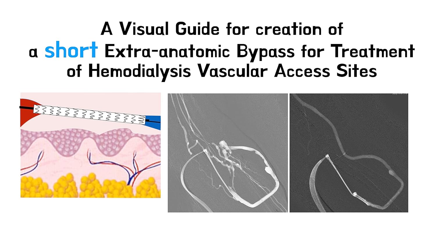 Amazon.com: A Visual Guide for creation of a short Extra-anatomic ...