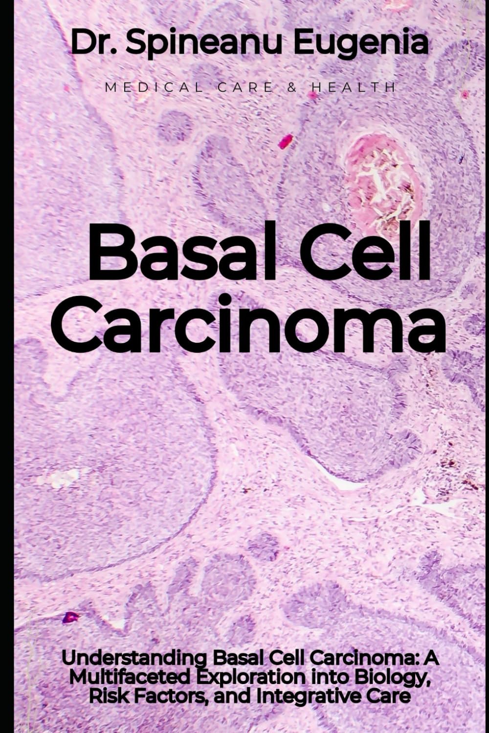 Understanding Basal Cell Carcinoma: A Multifaceted Exploration into ...