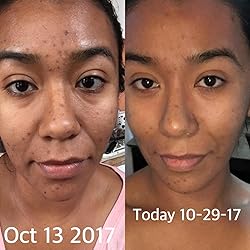 Amazon.com: DHT Block - DHT Blocker Supplement for Skin, Acne, PCOS ...