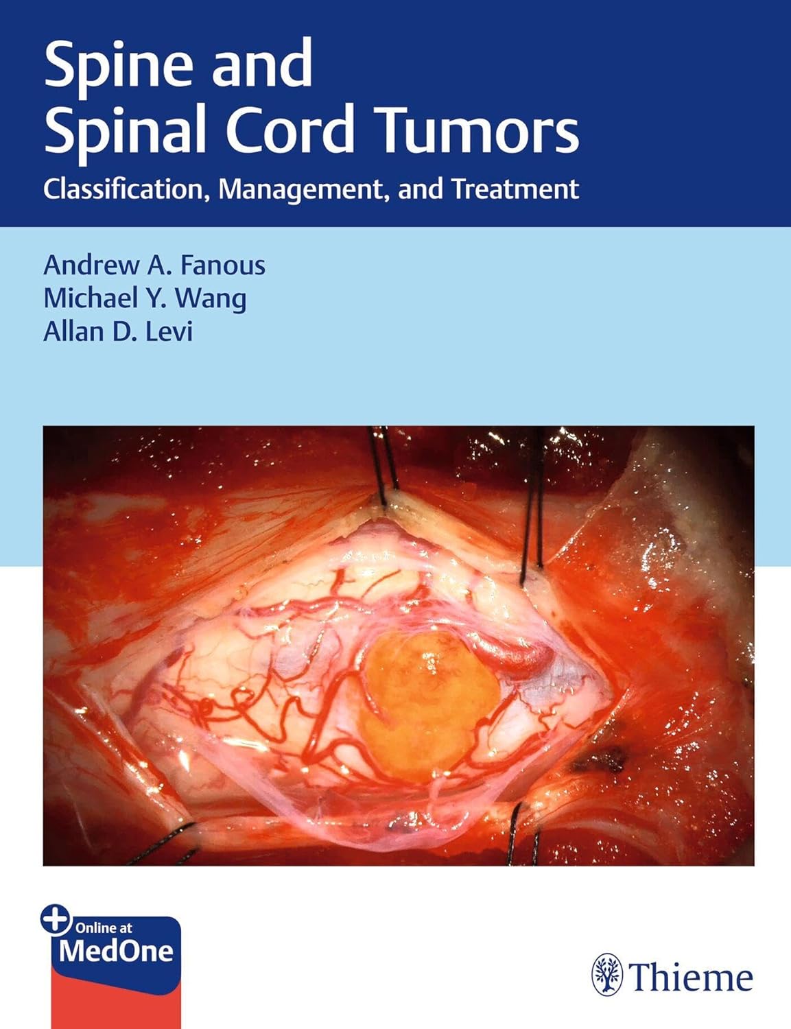 Amazon | Spine and Spinal Cord Tumors: Classification, Management, and ...