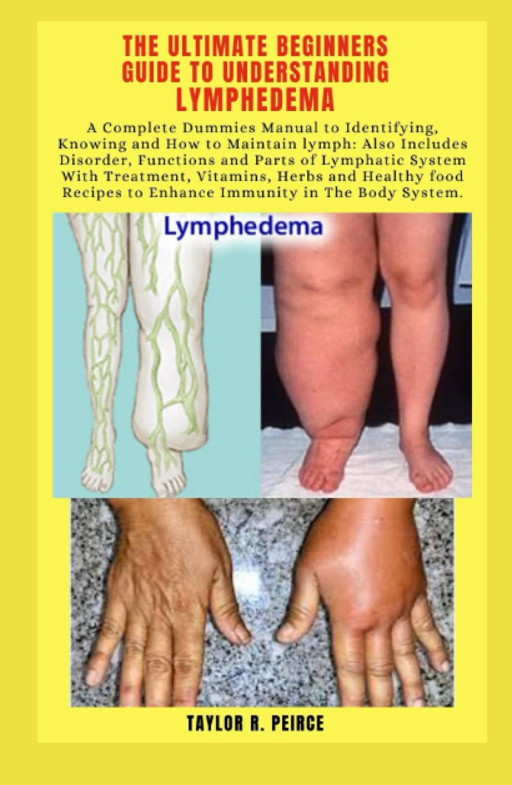 Buy THE ULTIMATE BEGINNERS GUIDE TO UNDERSTANDING LYMPHEDEMA: A ...