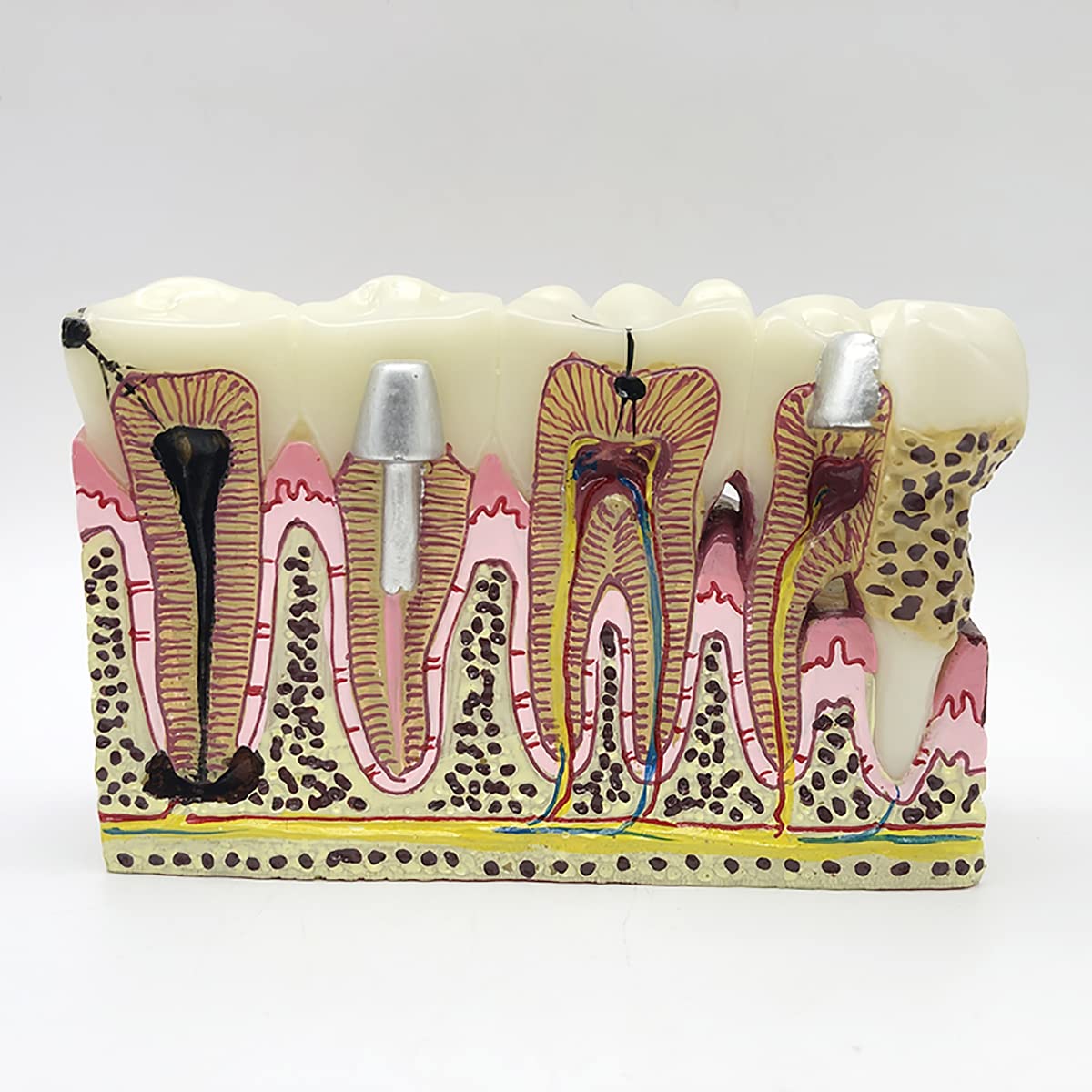Buy YHDL Tooth Pathology Model - Dental Calculus Model - Dental Oral ...