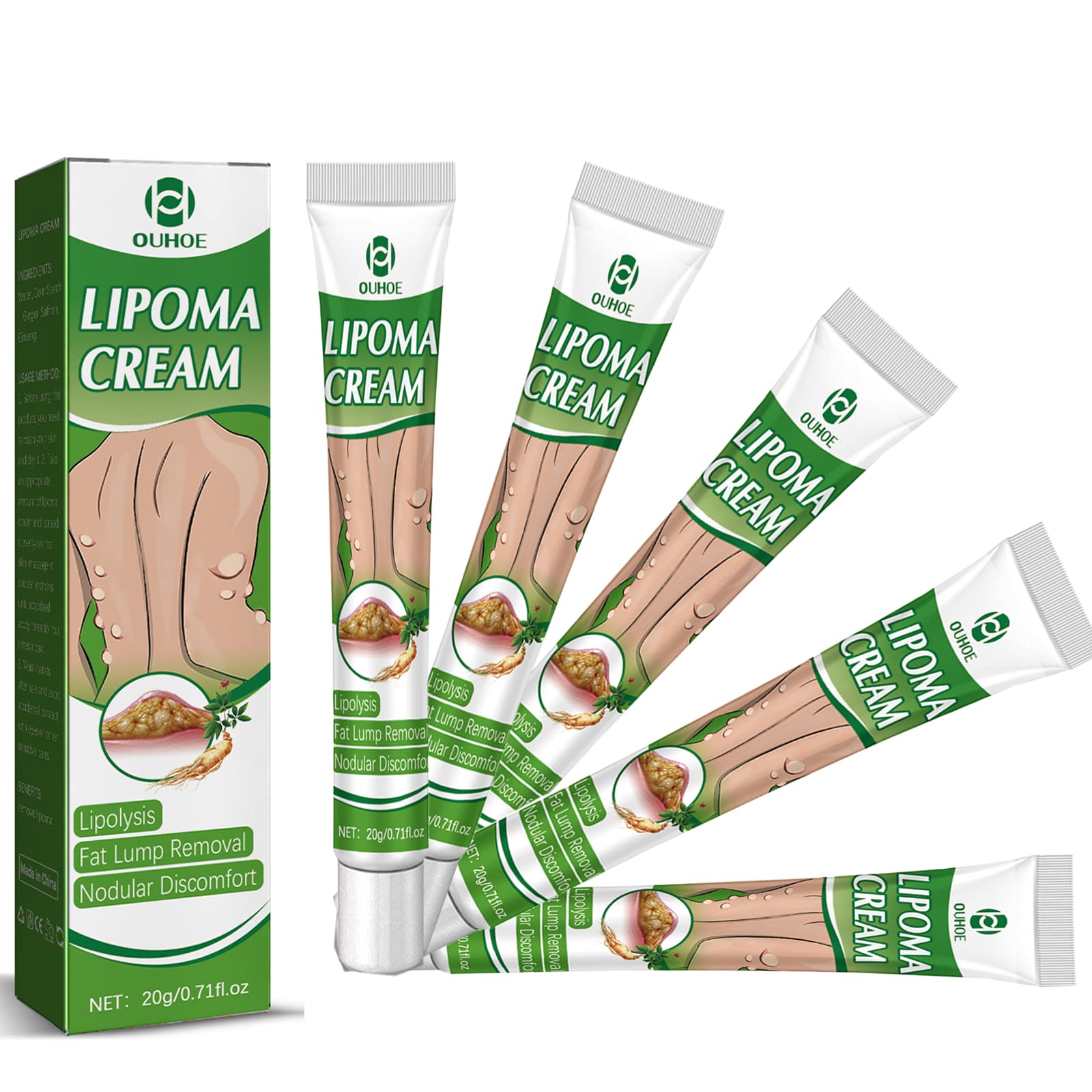 Buy Ynzix Lumpfree Lipoma Removing Cream ,Lipoma Elimination Cream,al ...