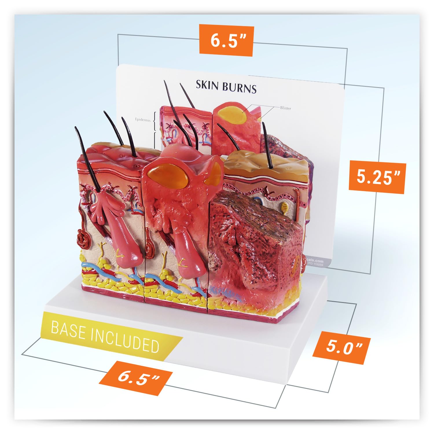 Snapklik.com : Skin Burn Model, Cross-Section Model Showing Normal And ...