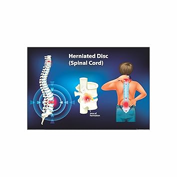 Anne Print Solutions® Herniated disc spinal cord Posters For Hospital ...