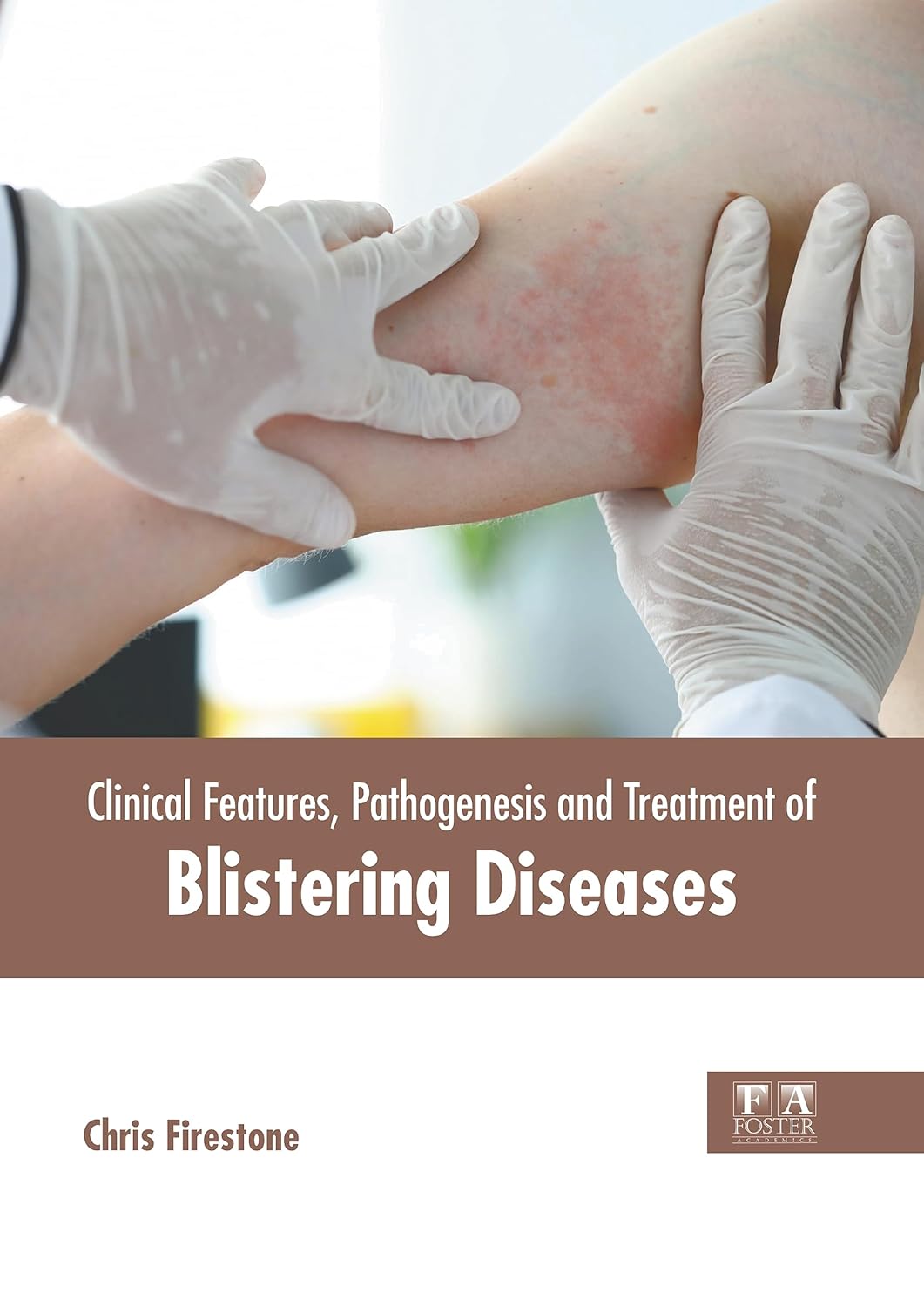 Clinical Features, Pathogenesis and Treatment of Blistering Diseases ...