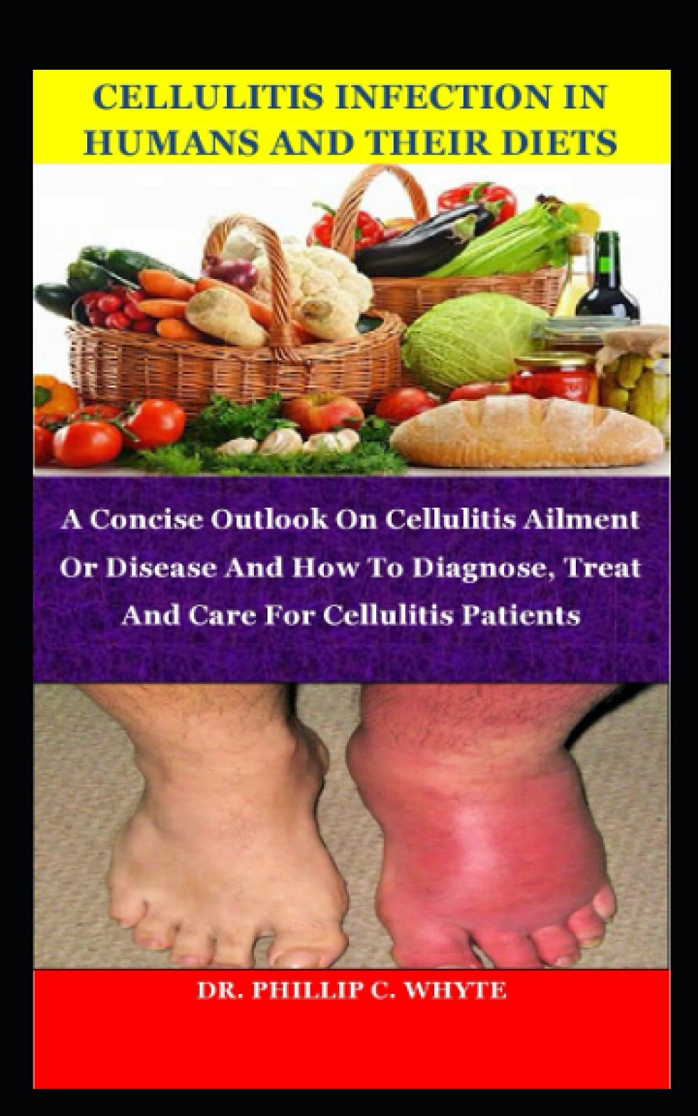 Buy CELLULITIS INFECTION IN HUMANS AND THEIR DIETS: A Concise Outlook ...