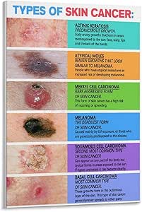Amazon.com: TYPES OF SKIN CANCER Poster Skin Hospital Wall Decoration ...