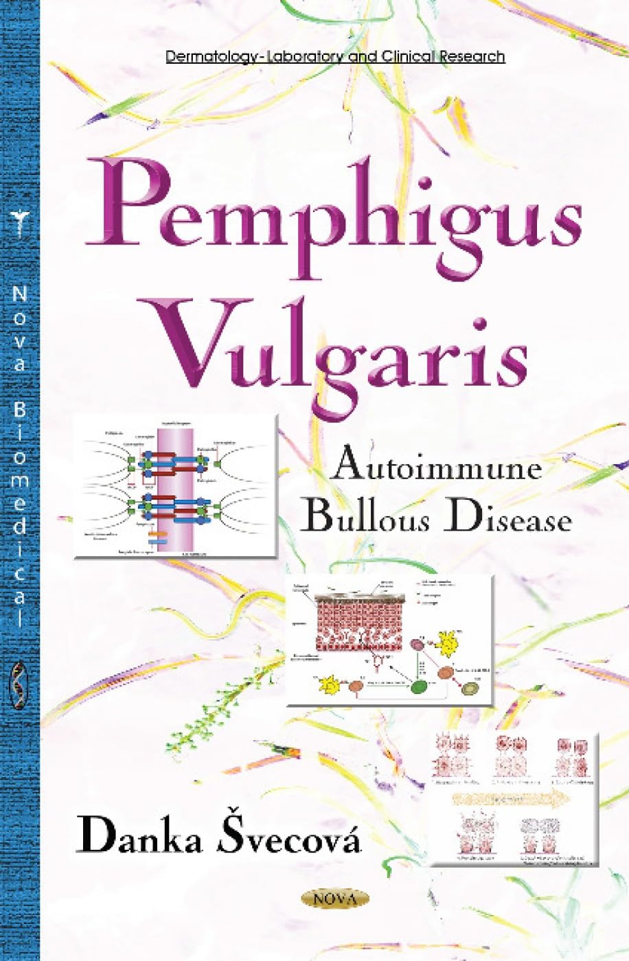 Pemphigus Vulgaris: Autoimmune Bullous Disease (Dermatology ...