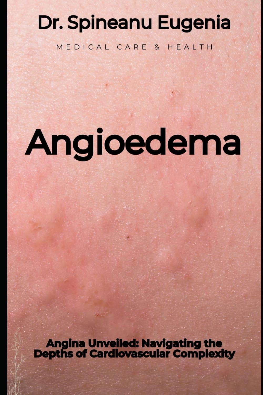 Angioedema Unveiled: A Comprehensive Exploration of Mechanisms ...