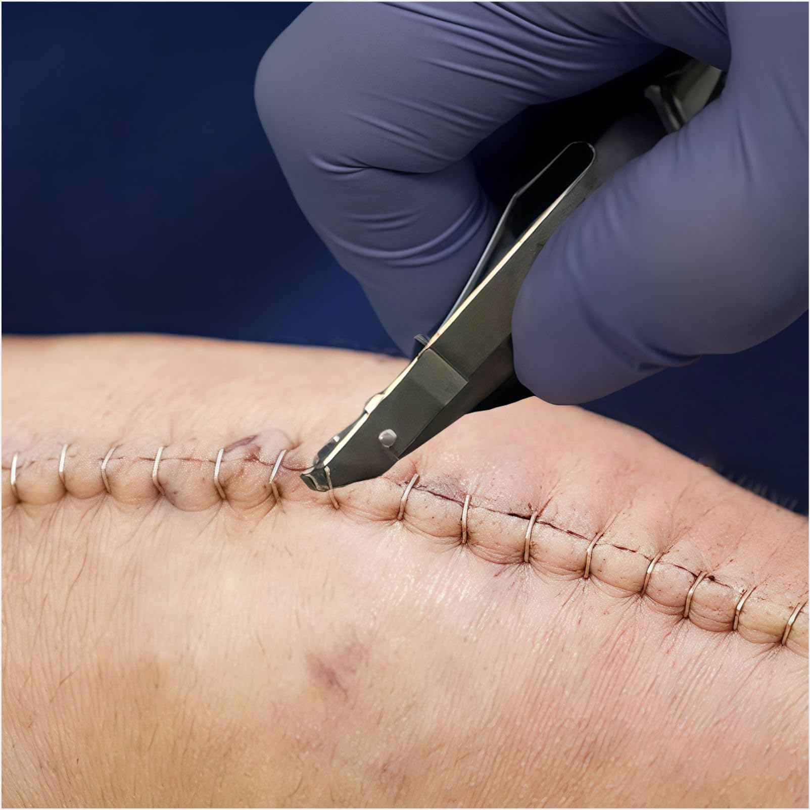 Staple Remover Tool For Wounds