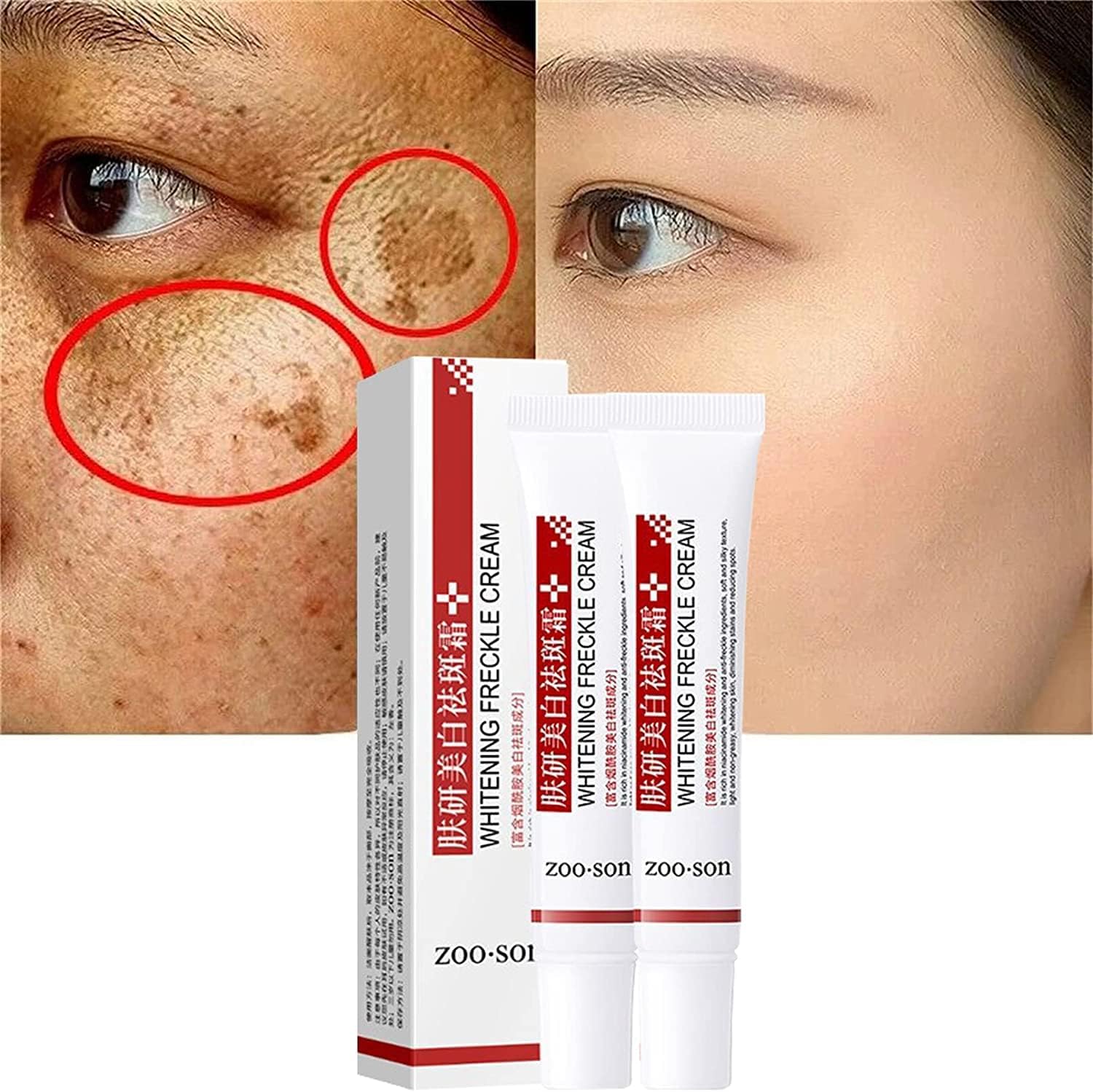 Whitening Freckle Cream, Pigmentation Removal Cream for Face, Freckle ...