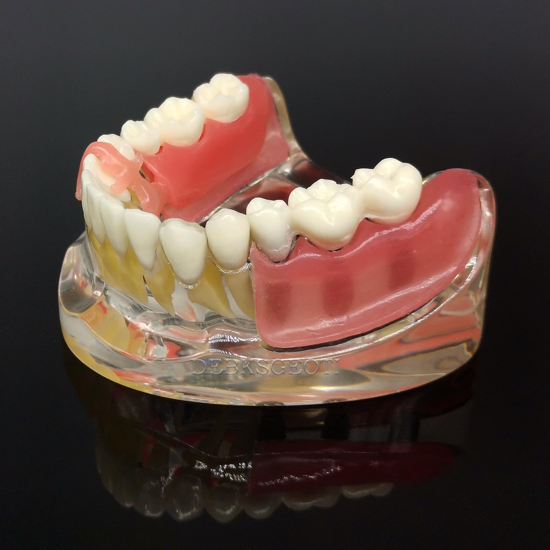 Snapklik.com : Dental Implant Typodont Restoration Teeth Model M6006 ...