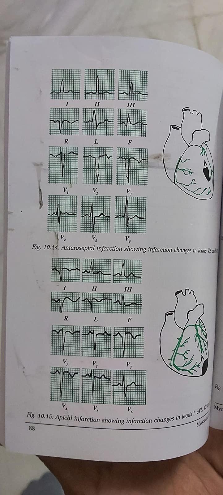 Understanding Ecg Electrocardiography 6Ed (Pb 2017) : MEHTA P.J ...