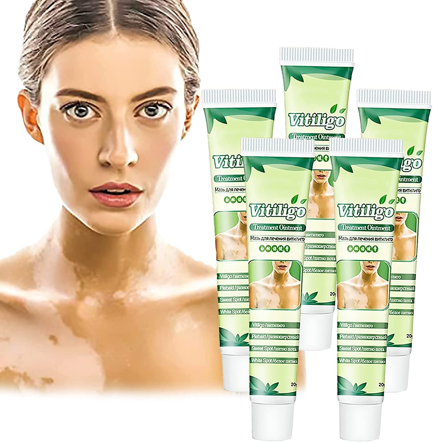 White Tag Treatment Moisturizing Cream Vitiligo Treatment Leukoplakia ...