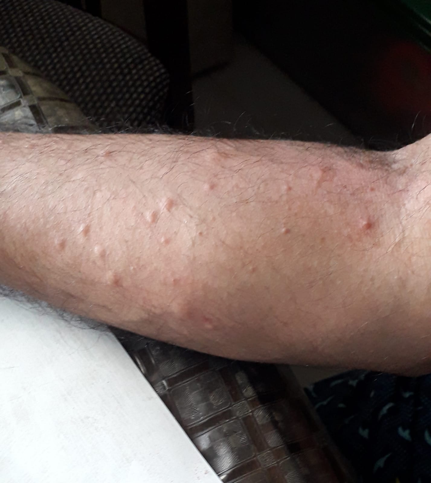 Buy Nagarjuna Psoria Oil (100ml) (Pack of 2) Online at Low Prices in ...