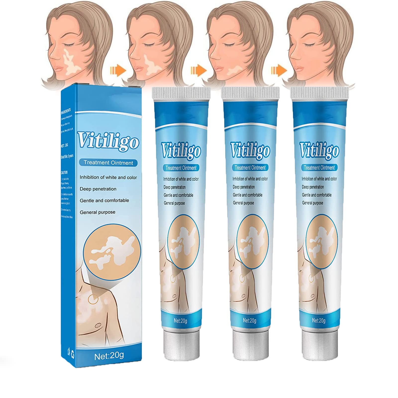 Buy MEDix's Vitiligo Cream, 20g White Spot Cream Vitiligo Cream ...