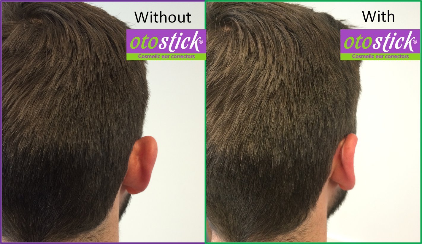 Otostick - Paquete triple - (...B019G23QP8 | Encarguelo.com