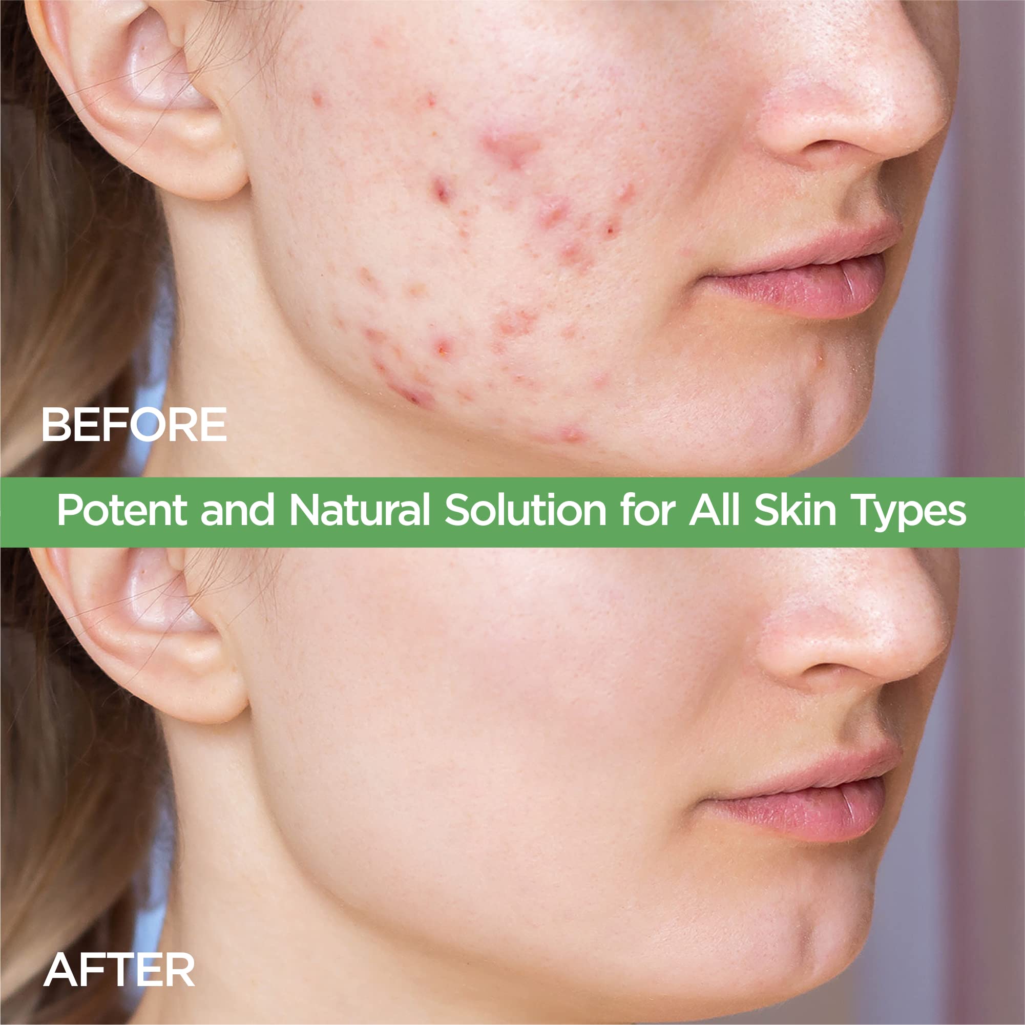 Snapklik.com : Acne Pills Supplement, Clear Skin Vitamins For Oily Skin ...