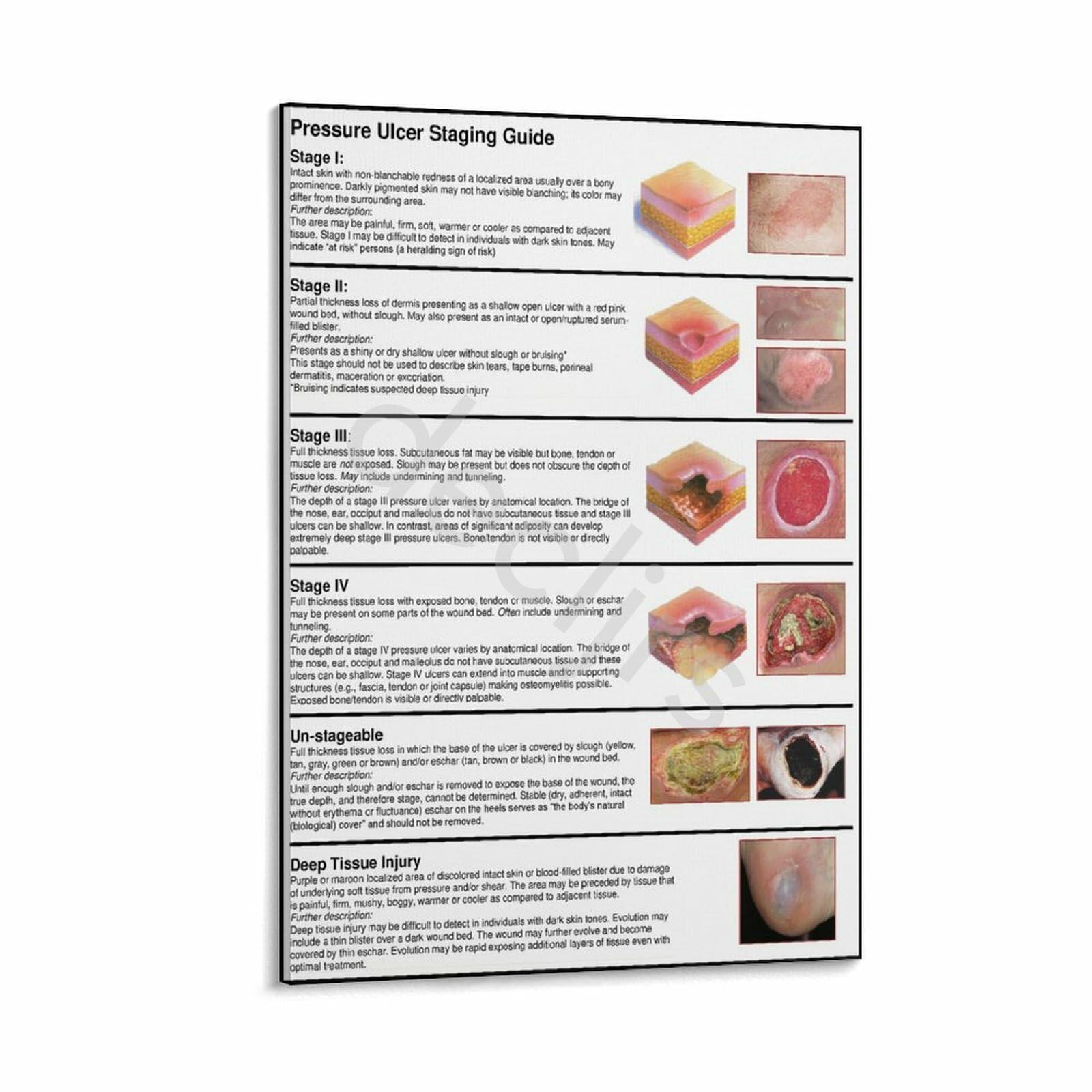 Pressure Ulcer Staging Guide Pressure Management Guide