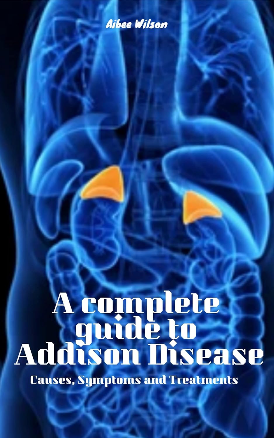 Amazon.com: A complete guide to Addison Disease: Causes, Symptoms and ...
