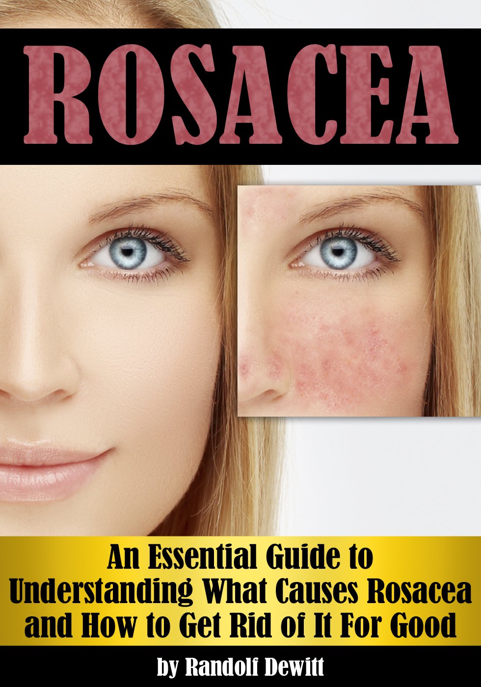 Rosacea: An Essential Guide to Understanding What Causes Rosacea and ...