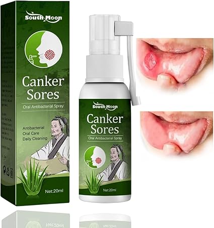 Mouth Ulcer Treatment Spray,Ulcer Breath Sprays,Mouth Ulcer Spray,Mouth ...