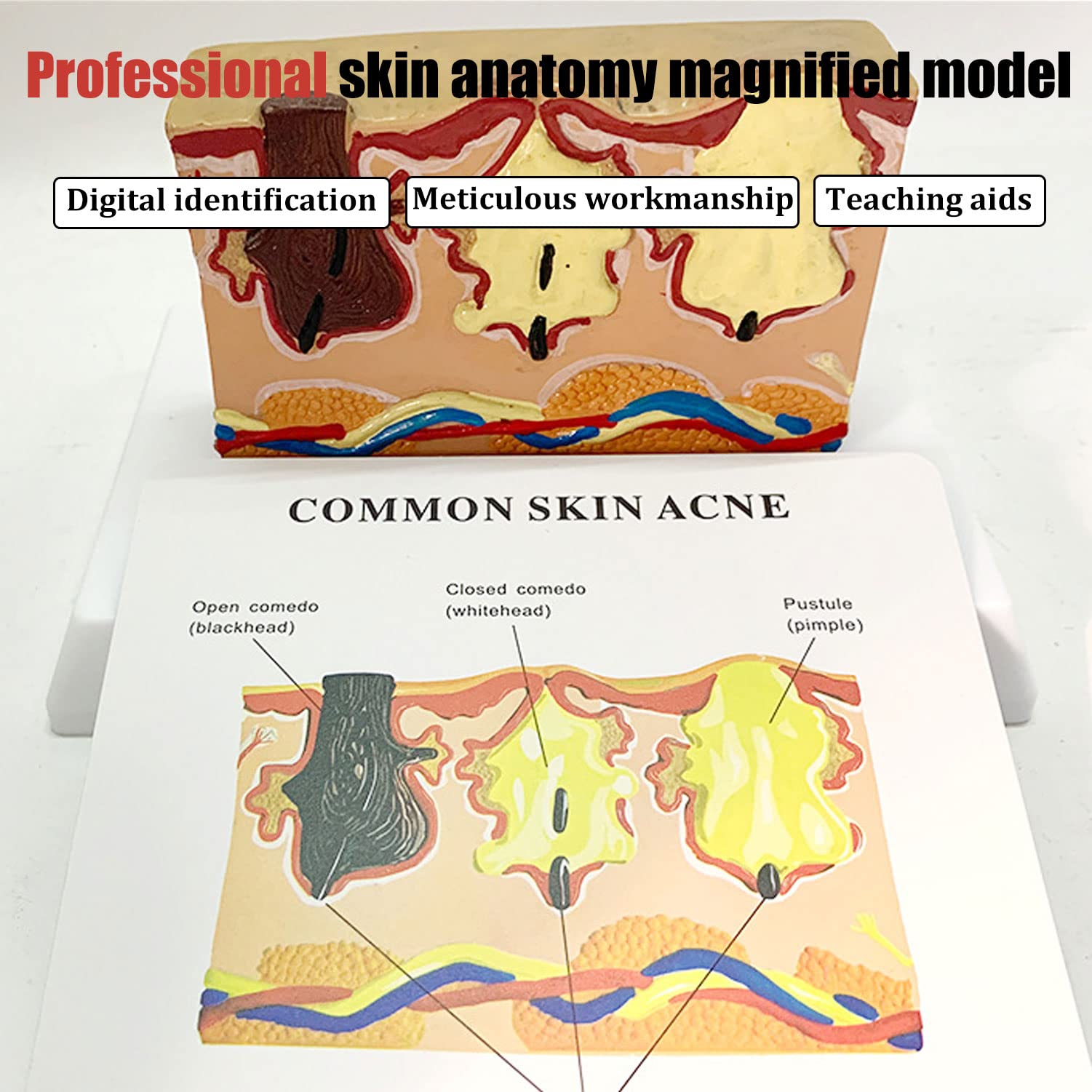 Anatomía Del Acné Acné Y Rosácea: Diagnóstico Y Tratamiento