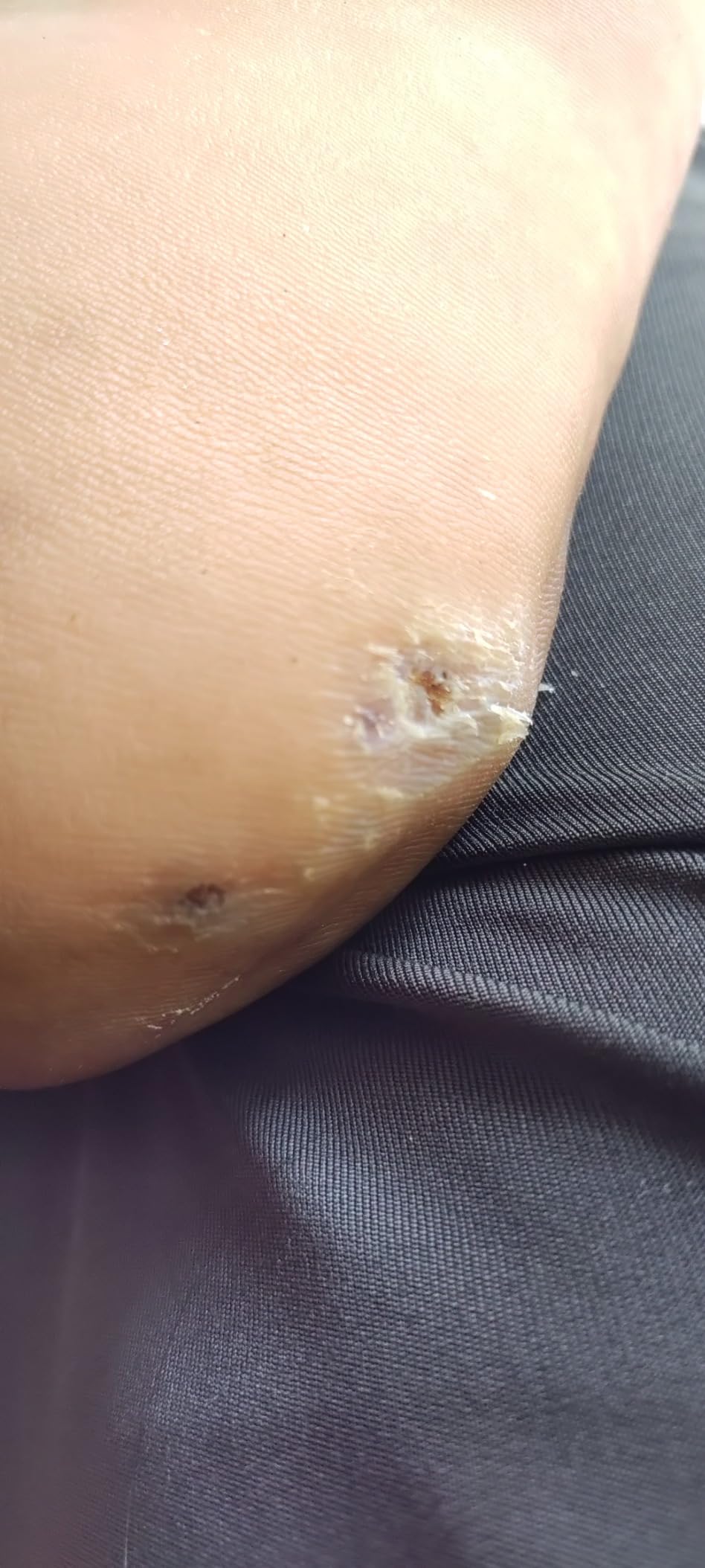 Buy Leeford Cornex Corn Cap, Corn Remover for Feet-Combo 20 Strips ...