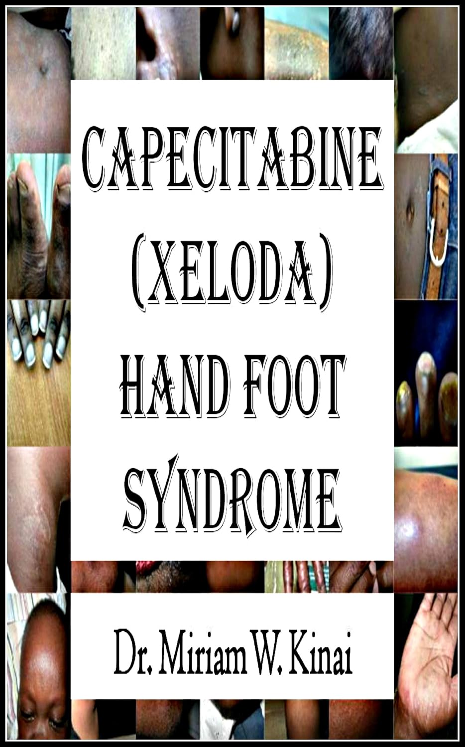 Capecitabine (Xeloda) Hand Foot Syndrome (Skin Diseases Book 14 ...