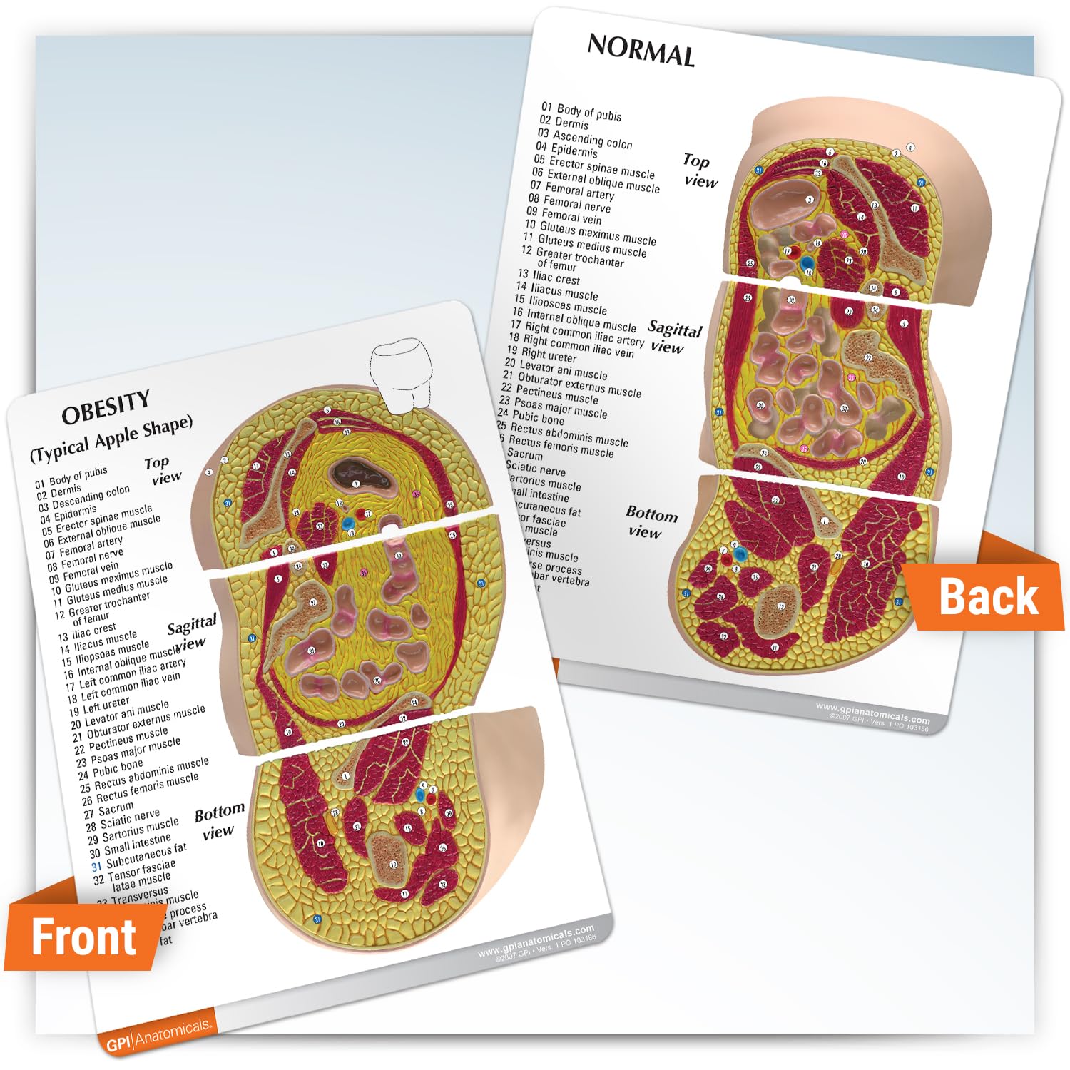 Snapklik.com : Obesity Model, Replica Of The Hip Area Depicting Effects ...