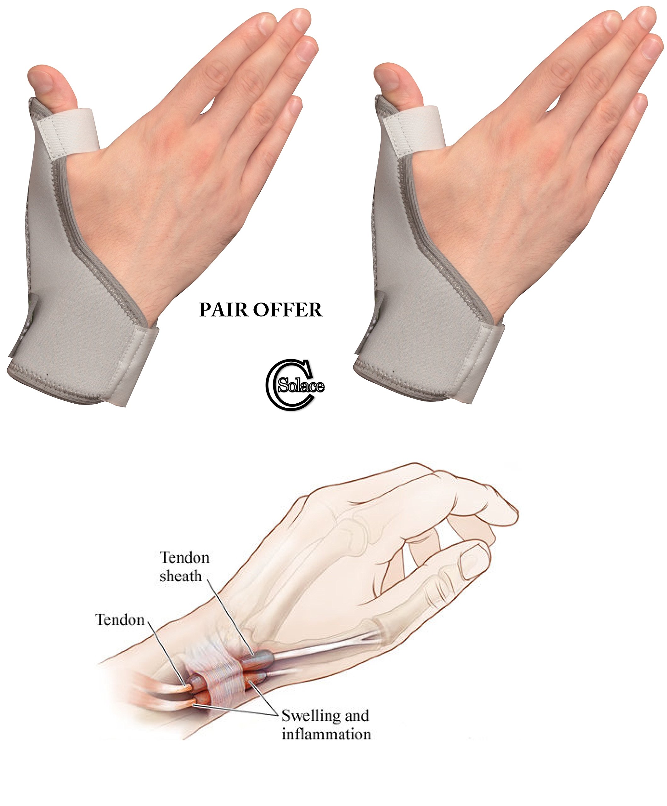 Median Nerve Injury Splint Recovering From Carpal Tunnel Surgery