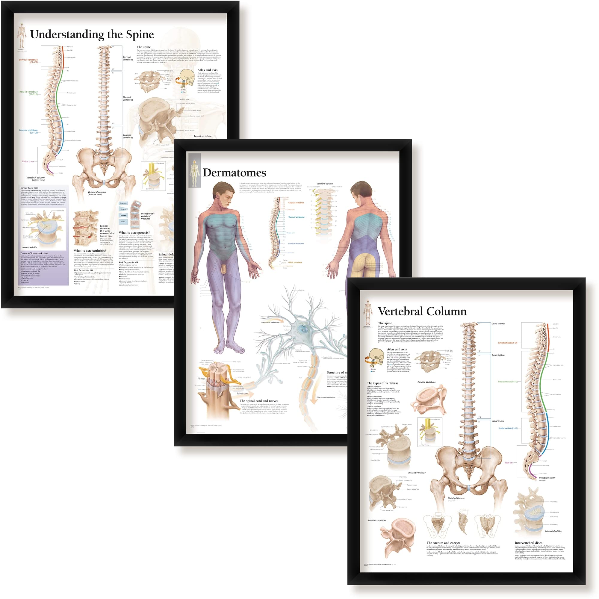 Amazon.com: Set of 3 Framed Medical Posters Understanding The Spine ...