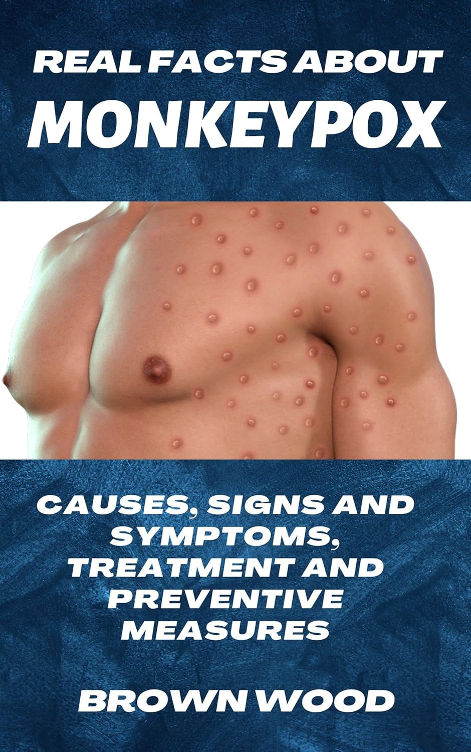 Amazon.com: REAL FACTS ABOUT MONKEYPOX: CAUSES, SIGNS and SYMPTOMS ...