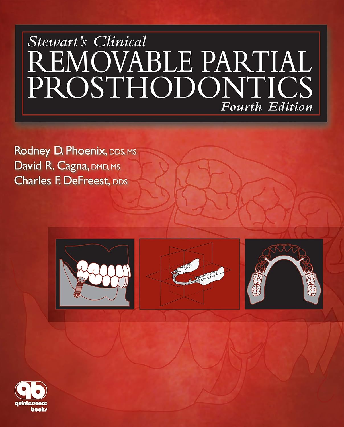 Amazon | Stewart's Clinical Removable Partial Prosthodontics: Fourth ...