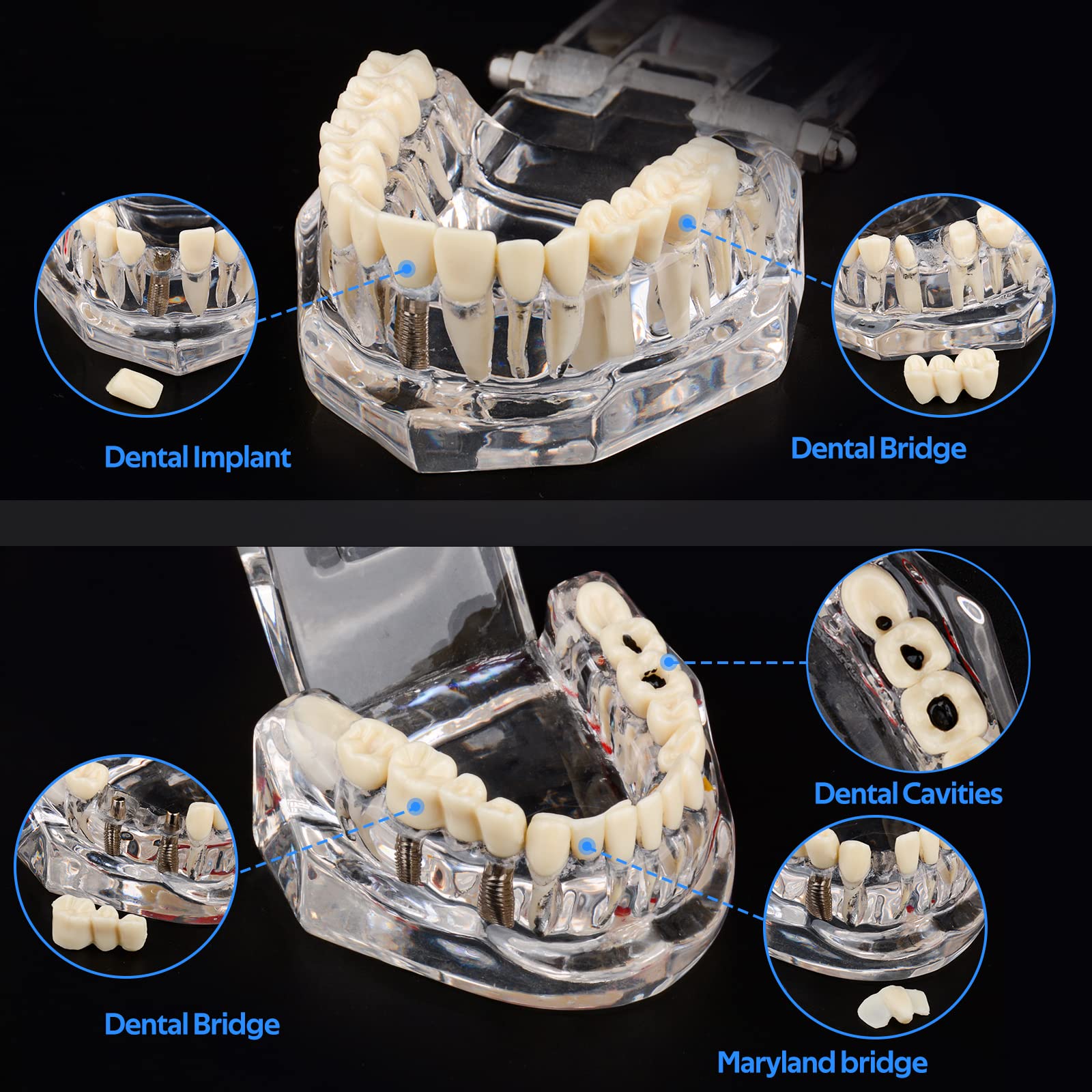Snapklik.com : Ultrassist Transparent Disease Teeth Model
