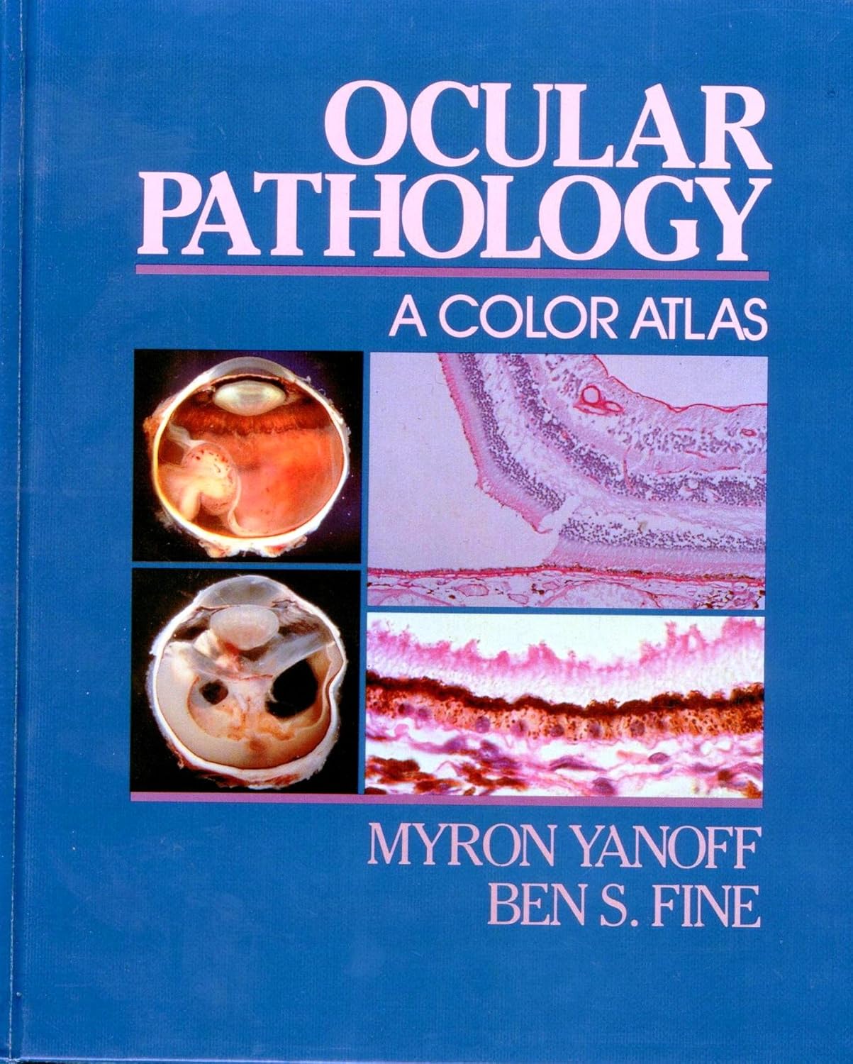 Ocular Pathology: A Color Atlas: Yanoff, Myron, Fine, Ben S ...