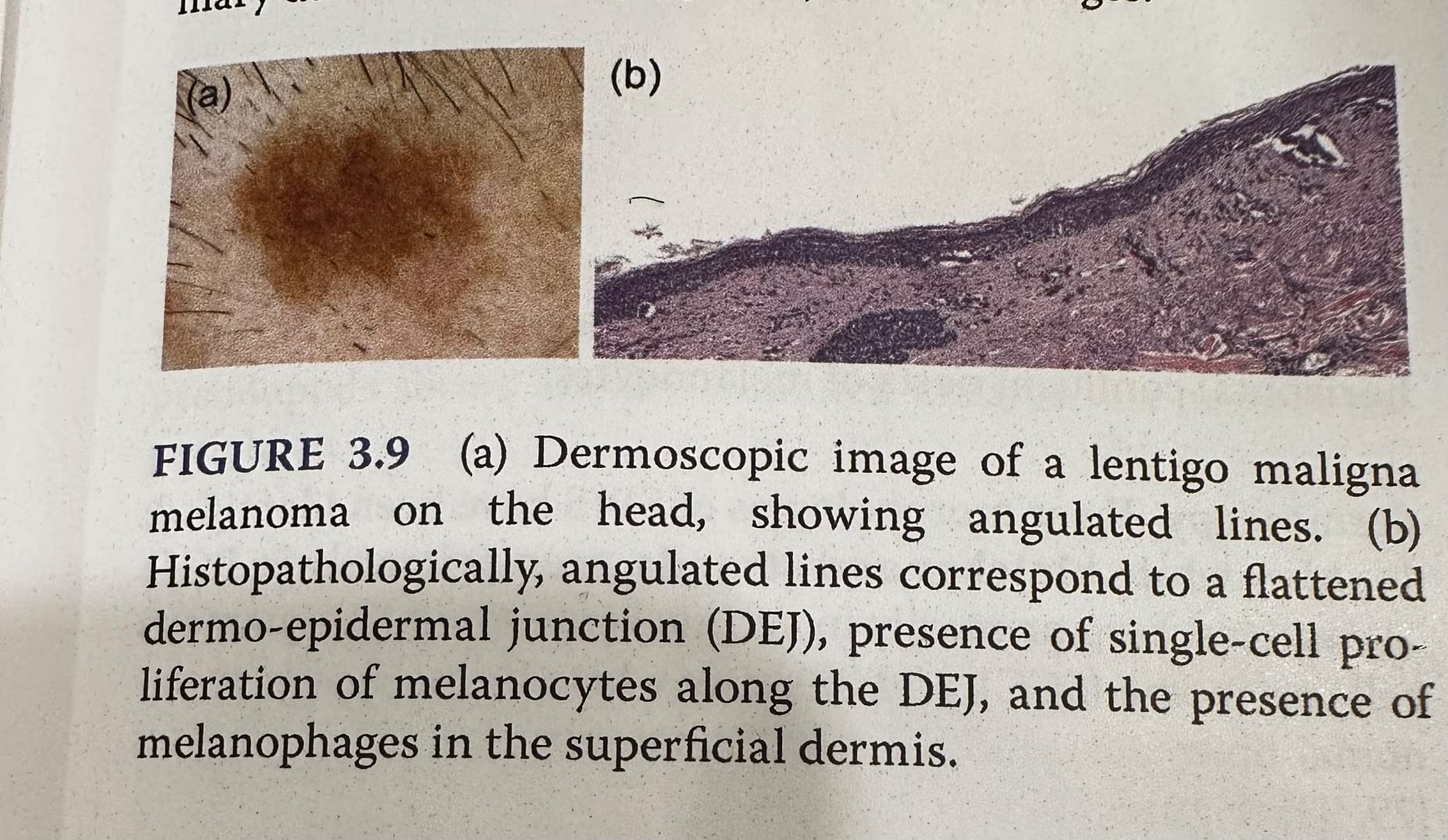 Atlas of Dermoscopy: Third Edition - Marghoob, Ashfaq A, Braun, Ralph ...