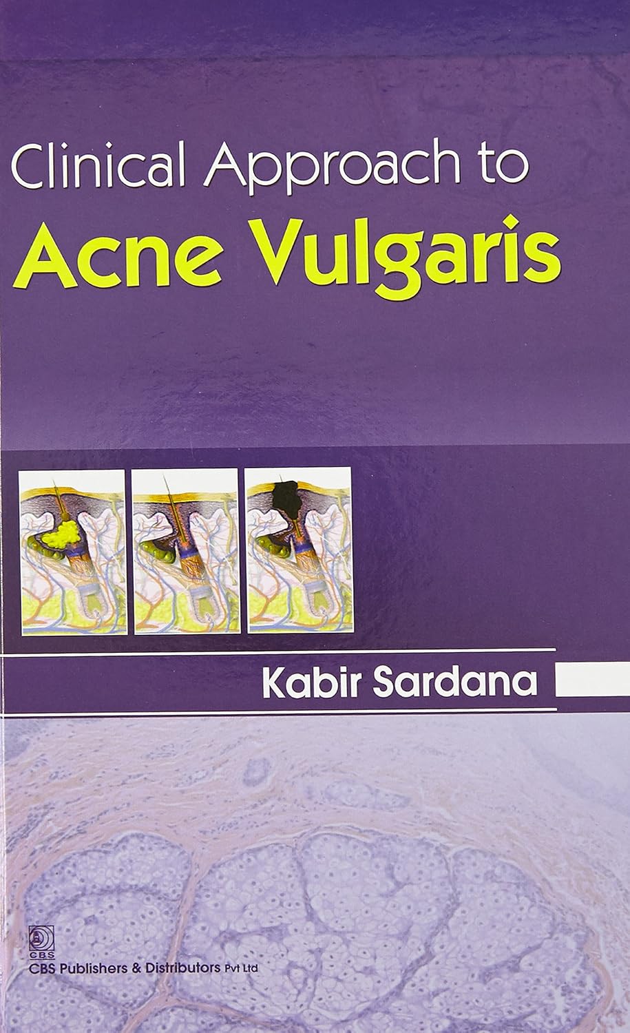 Clinical Approach To Acne Vulgaris (Hb- 2015): 9788123928357: Medicine ...