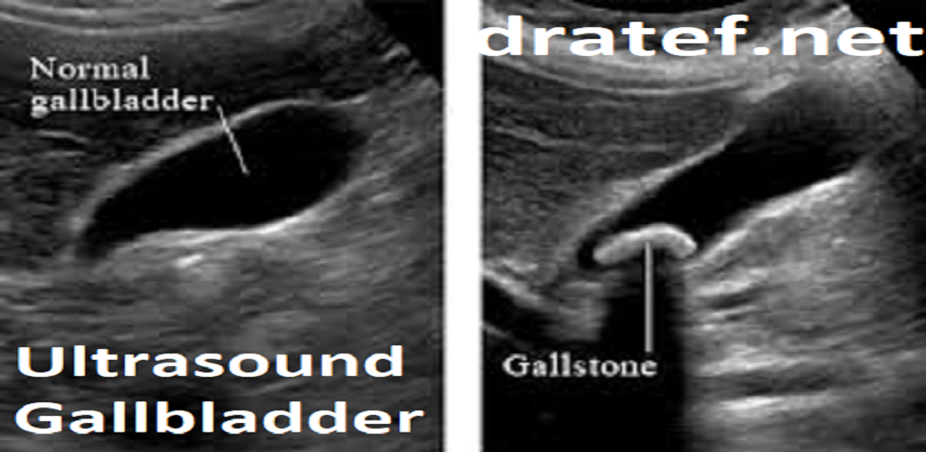 Abnormal Gallbladder Ultrasound Images