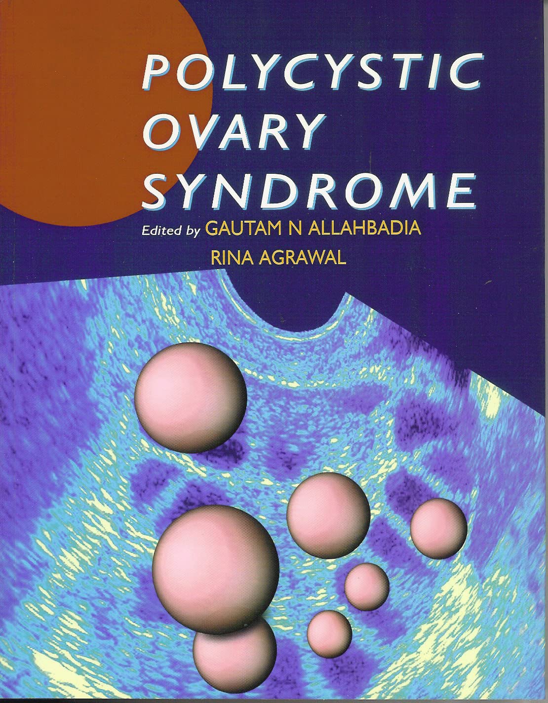 Polycystic Ovary Syndrome: Merchant, Rubina, Allahbadia, Gautam ...