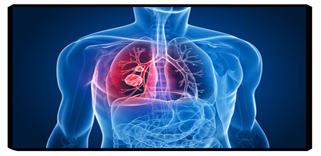 Bronchitis - App on Amazon Appstore