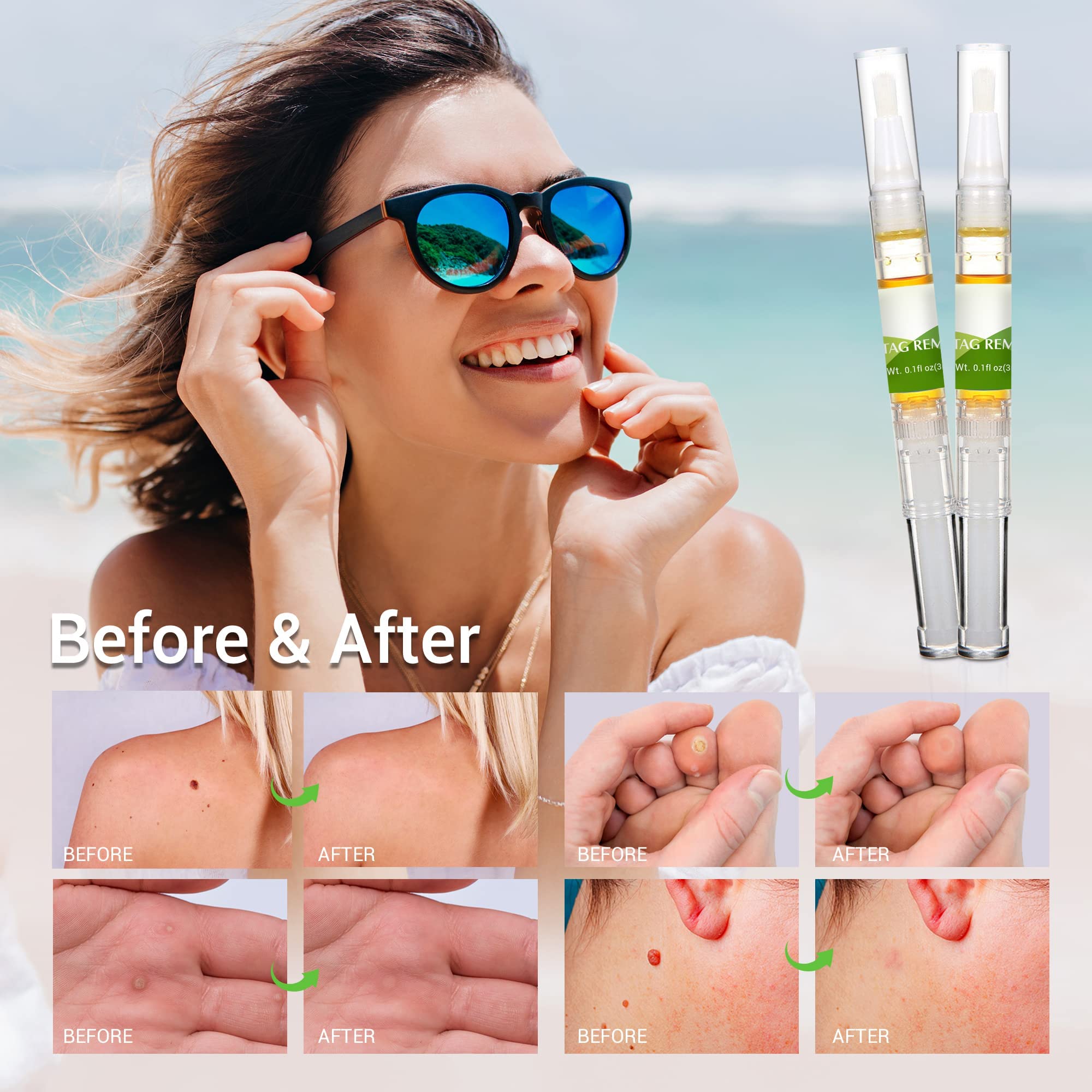 Natural Vine Skin Tag Remover, Safe & Effective Formula for Skin Tag ...